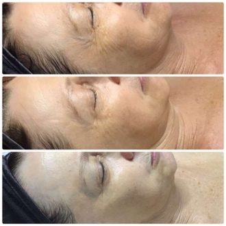 DMK Facials Melbourne | Anti-Aging | DMK Enzyme Treaments